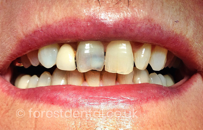 Reinserting A Knocked Out Tooth Clipart